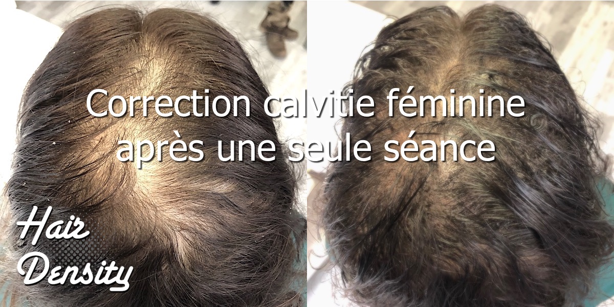 tricopigmentation sur Lausanne des cheveux, trichopigmentation